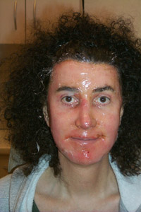 My Experience with Laser Skin Resurfacing